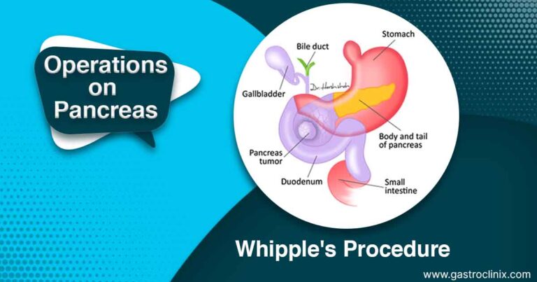 Whipple’s procedure - Dr. Harsh J Shah
